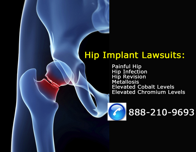 Stryker Metal Hip Failure, Recall and Lawsuits — Dallas Fort Worth ...